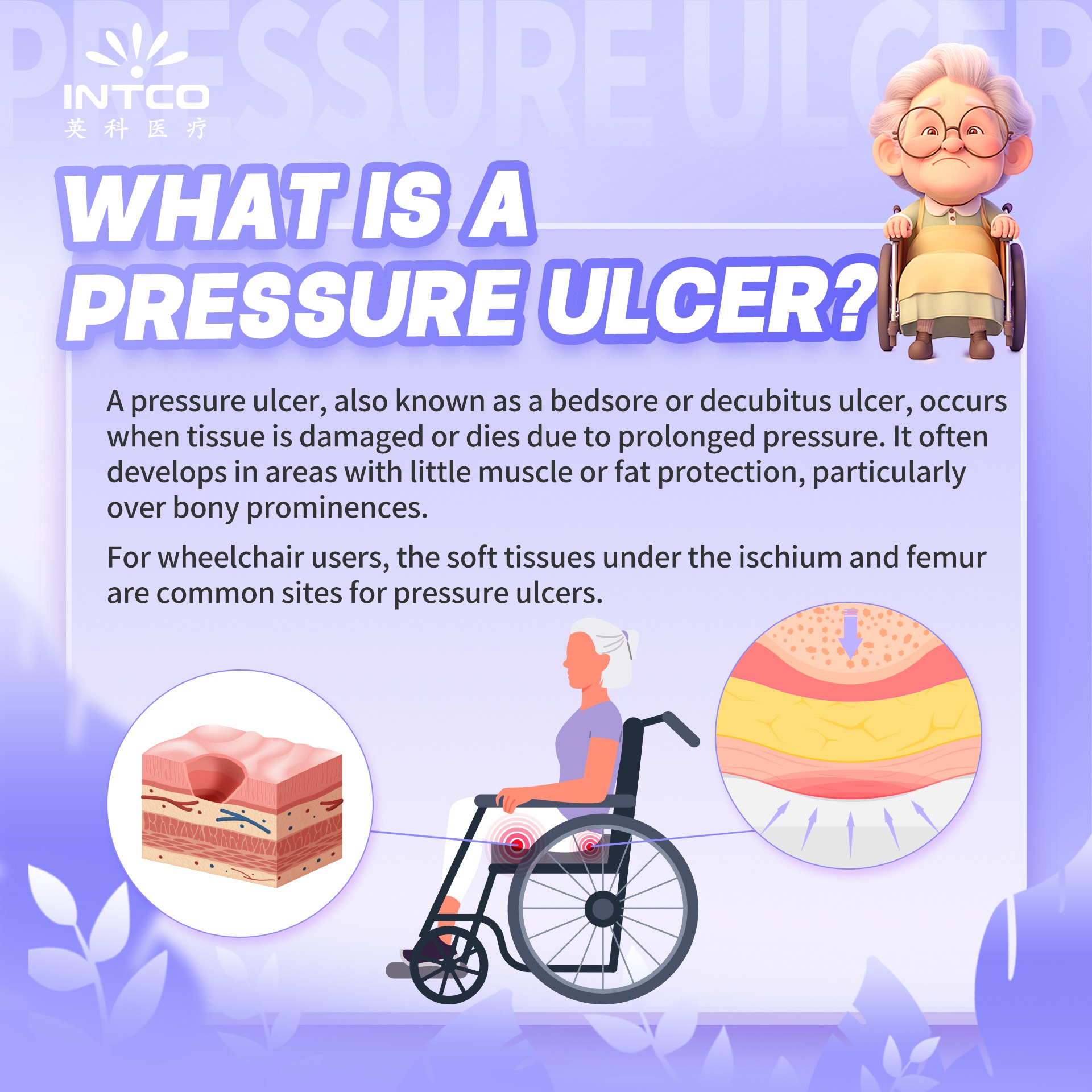 Effective Pressure Ulcer Care for Wheelchair Users